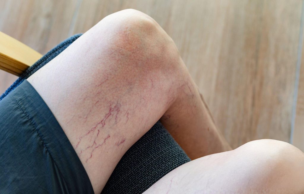 Understanding and Treating Spider Veins